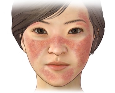 Lupus – The Bio Log