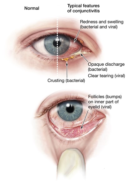 Conjunctivitis – The Bio Log